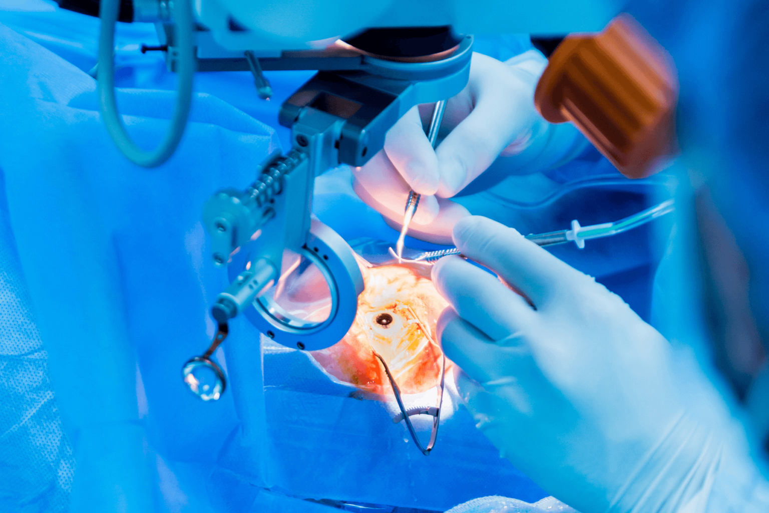 Cirugía del desprendimiento de retina – Vitrectomía – Ocularis